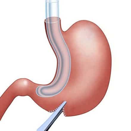 Gastric Sleeve Bougie Size Matter - Jet Medical Tourism® in Mexico