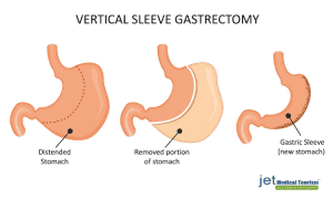 Vertical Sleeve Revision to Gastric Bypass | VSG to RNY