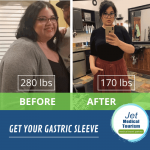 Gastric Sleeve Before and After Pictures: Best VSG Photos (2022)