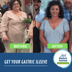 Gastric Sleeve Before and After Pictures: Best VSG Photos (2022)