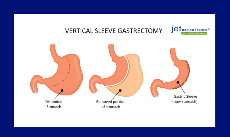 Vertical Sleeve Gastrectomy