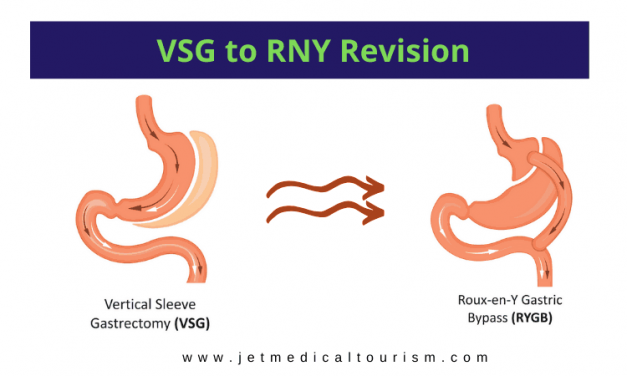 Vertical Sleeve Revision to Gastric Bypass | VSG to RNY
