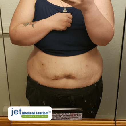Gastric Sleeve Scars - Minimize Scars to Stomach - Jet Medical Tourism® in Mexico