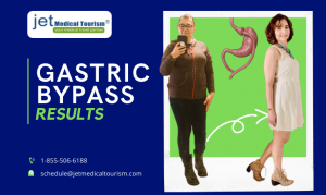 Gastric Bypass Results - Jet Medical Tourism® in Mexico