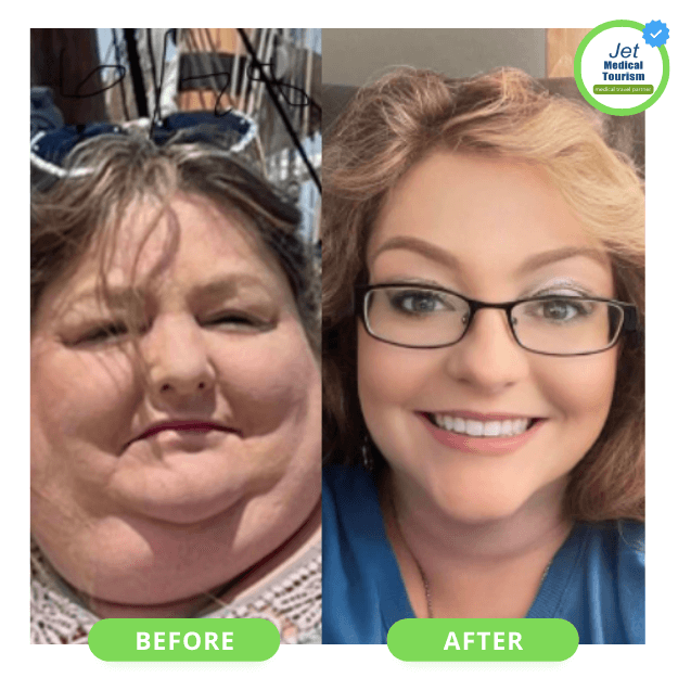 Bariatric Surgery Tijuana Mexico - Jet Medical Tourism®