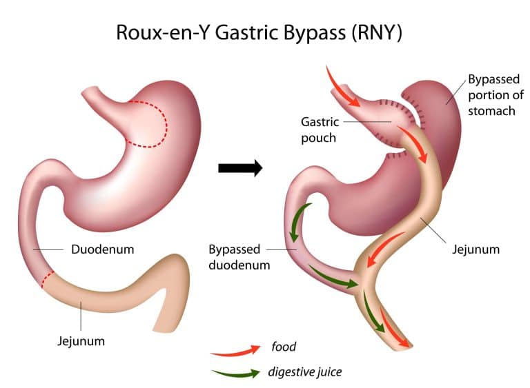 Gastric Bypass Mexico | Roux-en-Y Gastric Bypass (RNY) Tijuana | $5,499