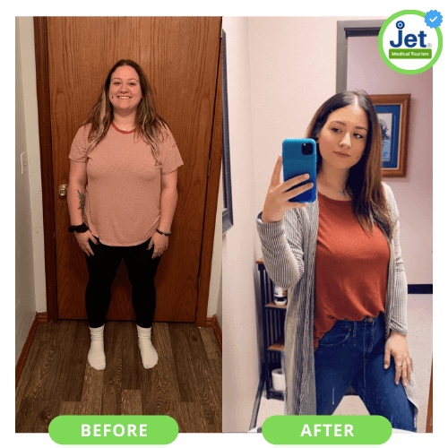 Gastric Sleeve Before And After Pictures Best Vsg Photos 2023