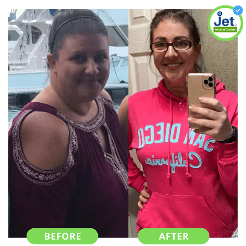 Gastric Sleeve Before And After Pictures Best Vsg Photos 2023