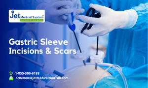 Gastric Sleeve Incisions, Illustrations - Jet Medical Tourism®